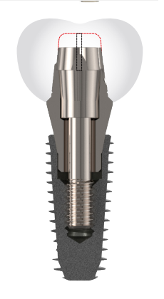 Ưu điểm của dòng Implant Yes Biotech: