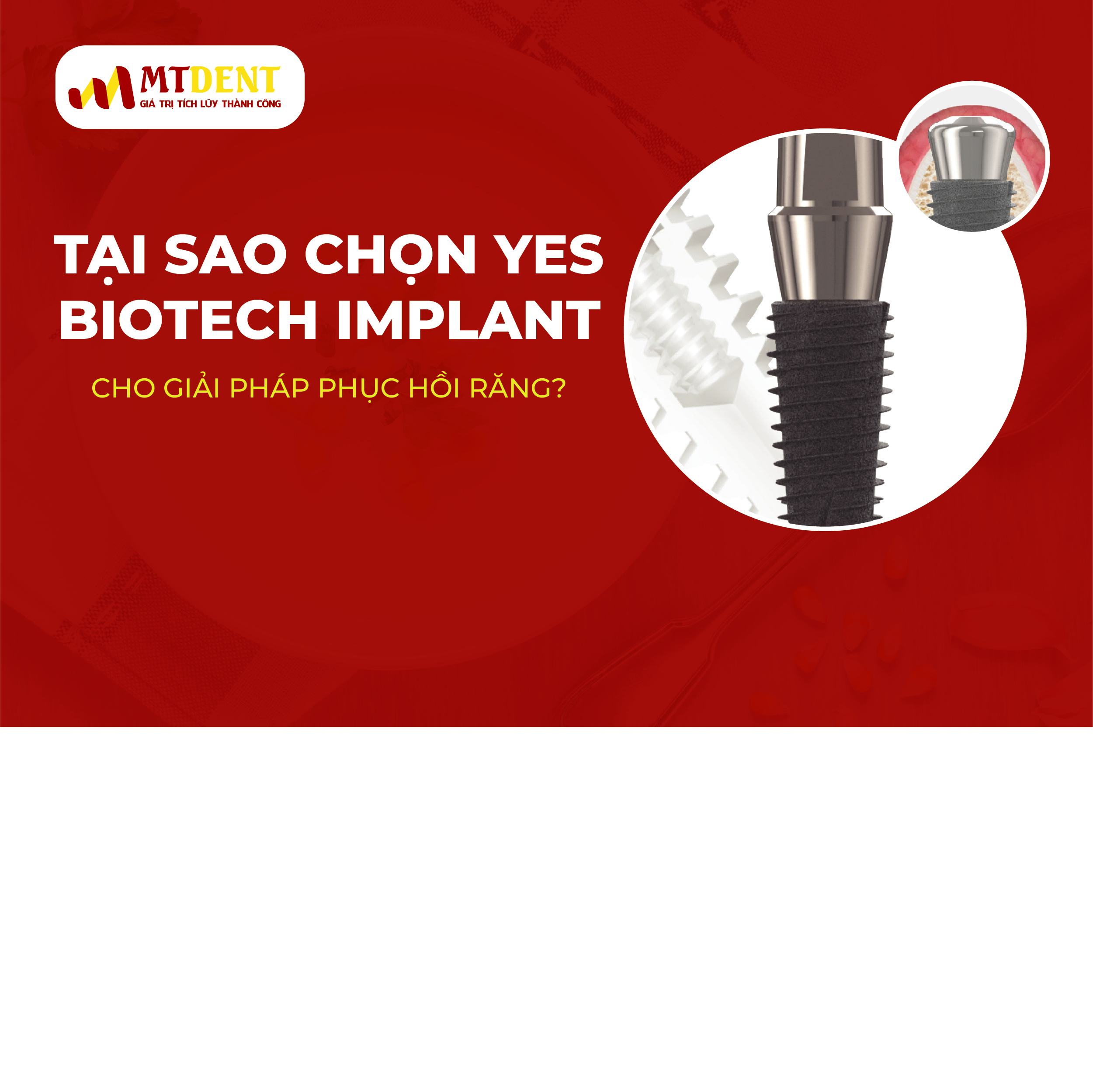 tai-sao-chon-yes-biotech-implant-1.png